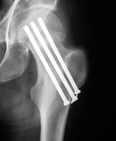 Synthes Cannulated Screws (Implant 241) - orthopaediclist.com