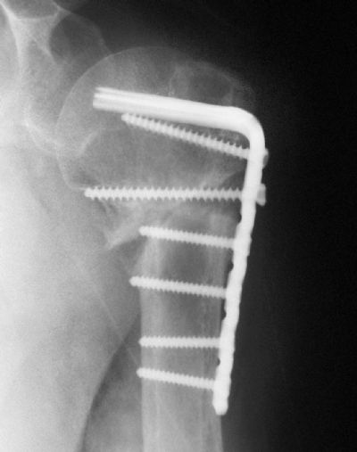 Implant Identification - orthopaediclist.com