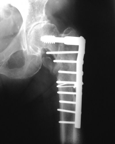 Hip Fracture Fixation (Femur, Proximal) - orthopaediclist.com