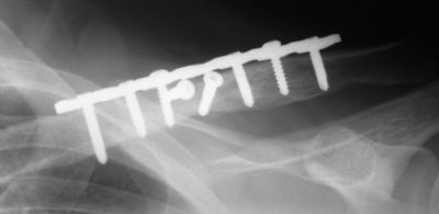 Implant Identification - orthopaediclist.com