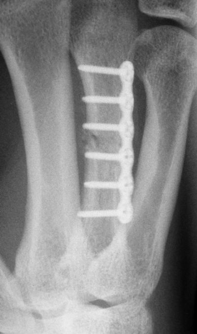 Hand Implants - orthopaediclist.com