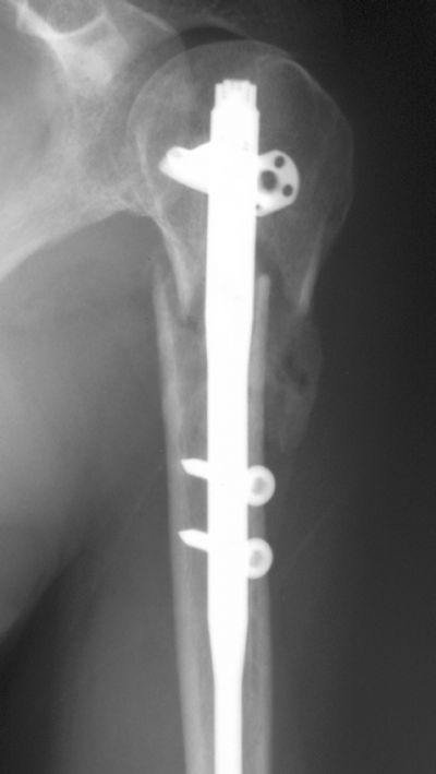 Implant Identification - orthopaediclist.com