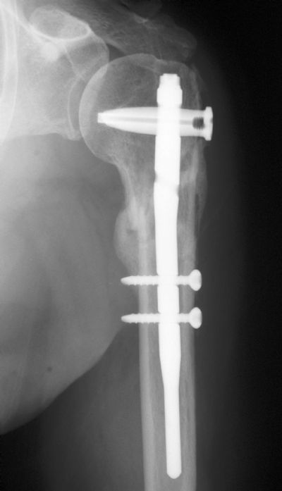 Humerus Fracture Fixation: Proximal - orthopaediclist.com