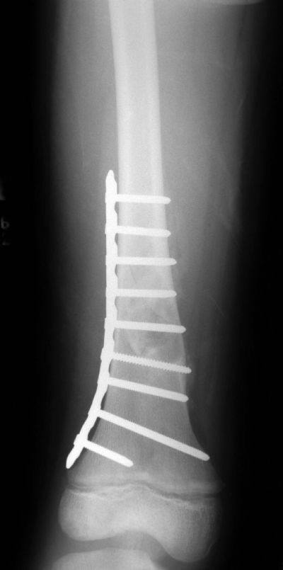 Stainless LCP (Implant 256) - orthopaediclist.com