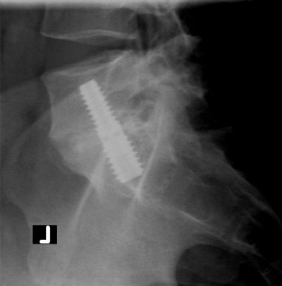 Positioners, Shoulder Surgery - orthopaediclist.com