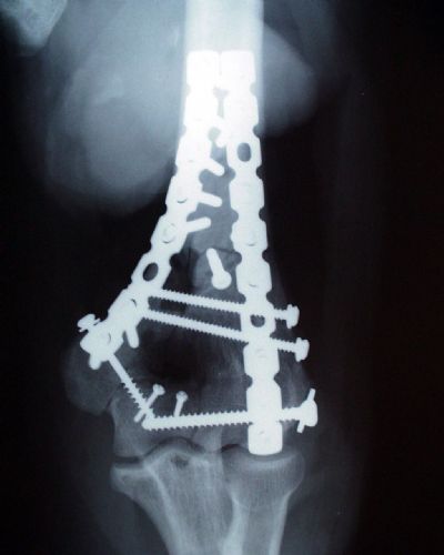 Implant Identification - orthopaediclist.com