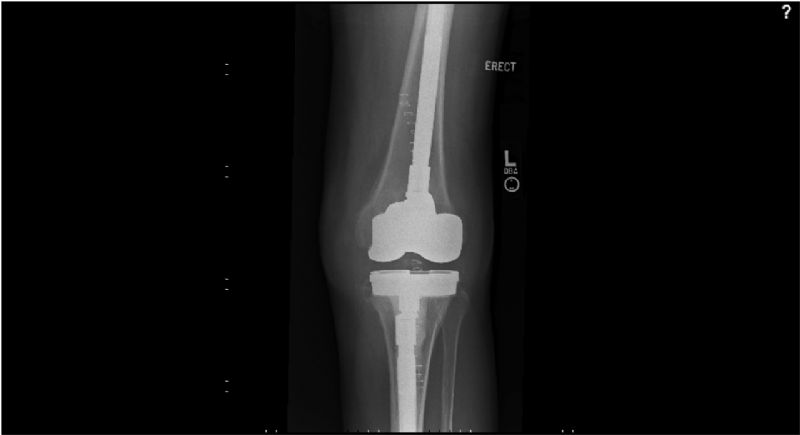 Knee Prostheses: Total, Revision - orthopaediclist.com