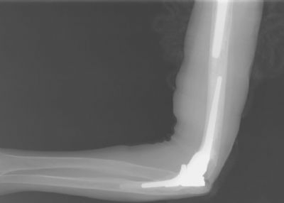 Solar Total Elbow Prosthesis (Implant 86) - orthopaediclist.com