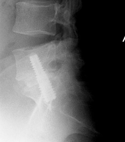 Implant Identification - orthopaediclist.com