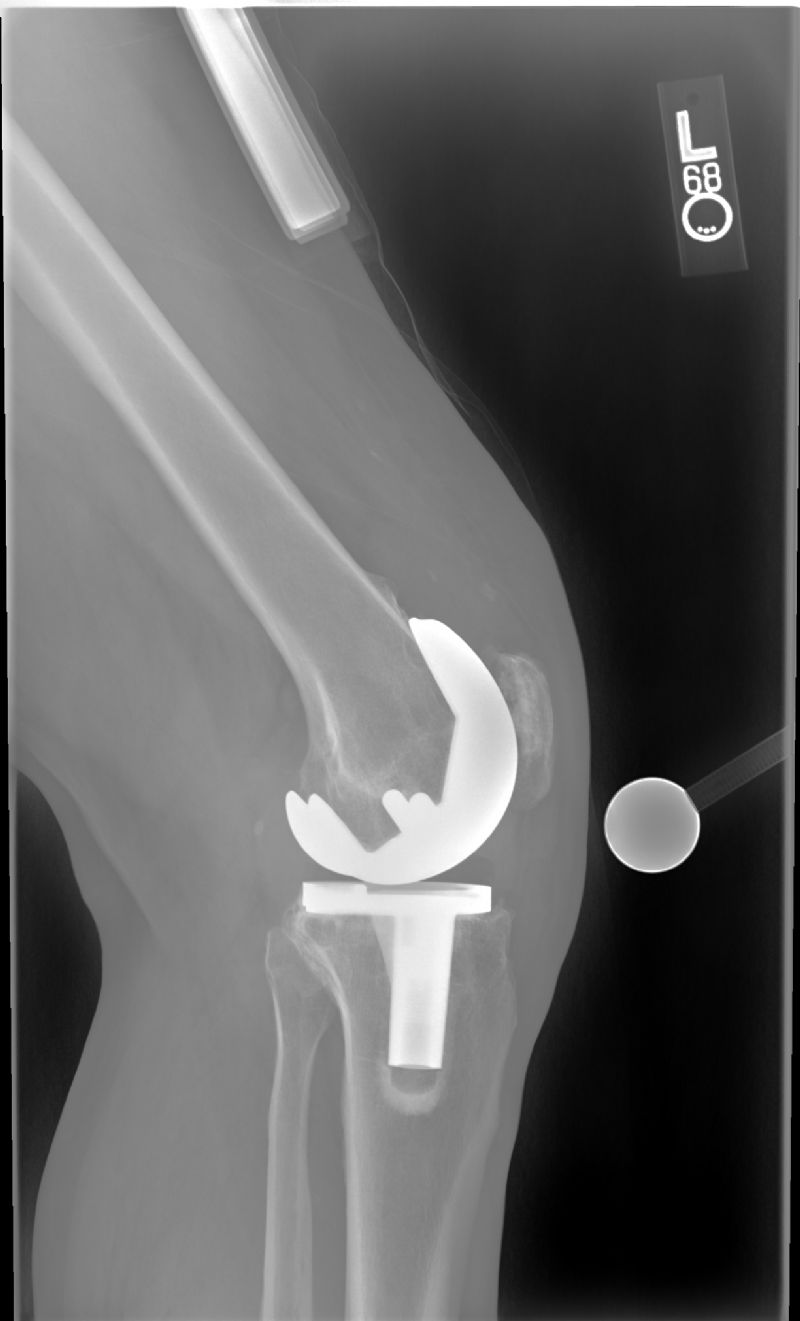 Knee Prostheses: Total, Primary - orthopaediclist.com