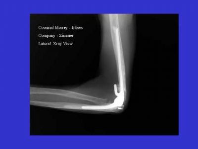 Elbow Prostheses: Total - orthopaediclist.com
