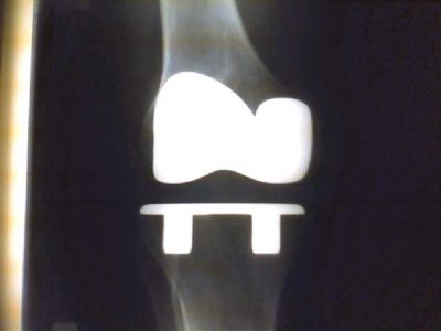 Implant Identification - orthopaediclist.com