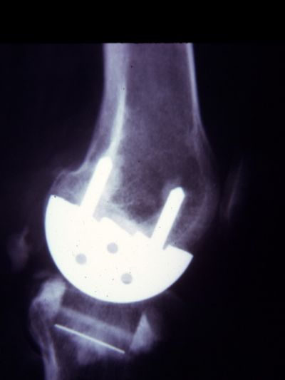 Knee Prostheses: Unicompartmental / Interpositional - orthopaediclist.com