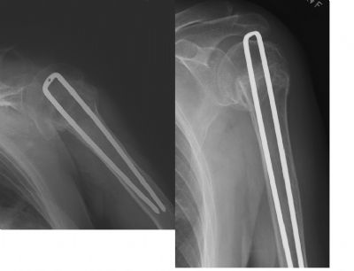 Implant Identification - orthopaediclist.com