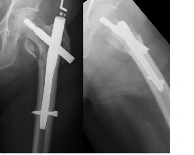 Hip Fracture Fixation (Femur, Proximal) - orthopaediclist.com