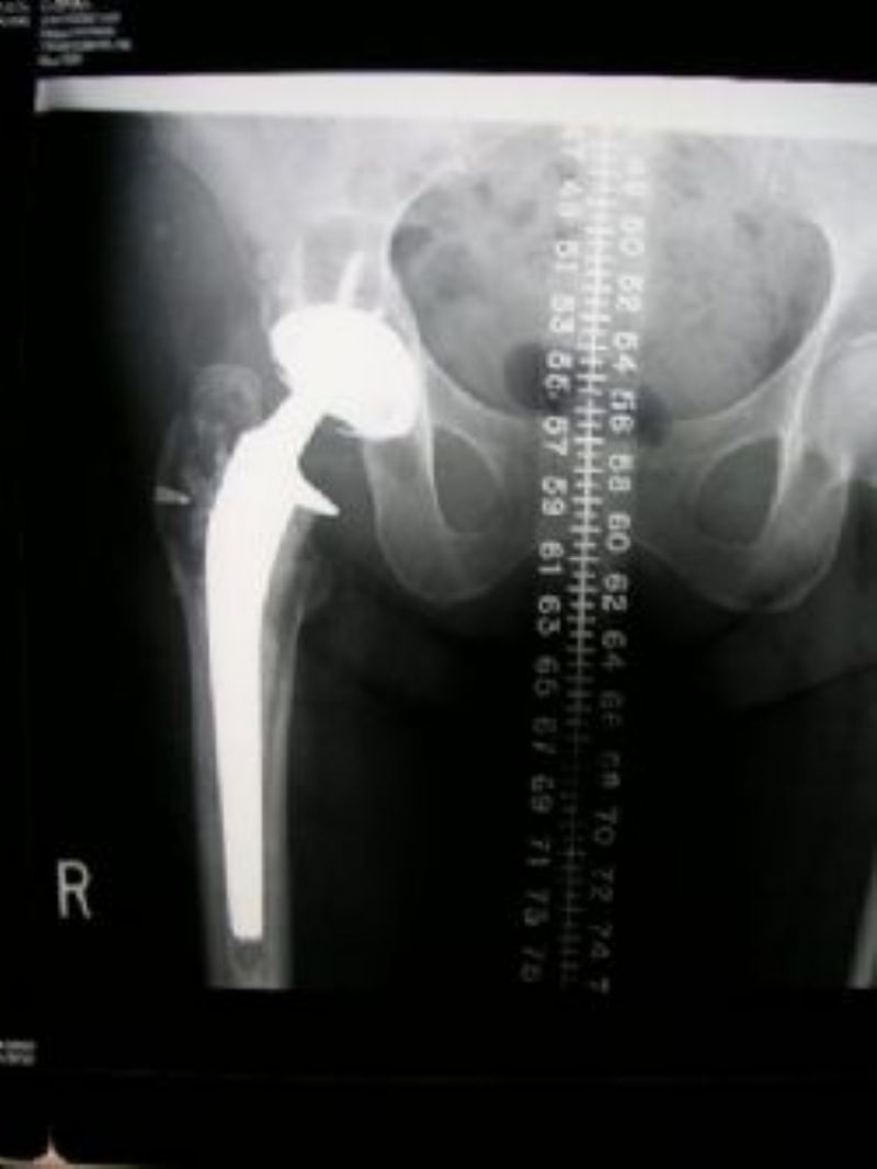 Implant Identification - orthopaediclist.com