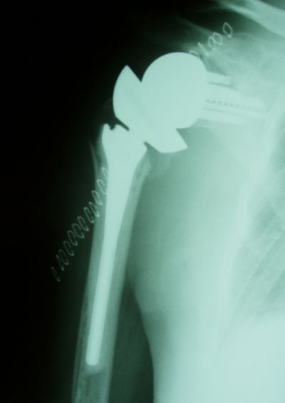 Shoulder Prostheses - orthopaediclist.com