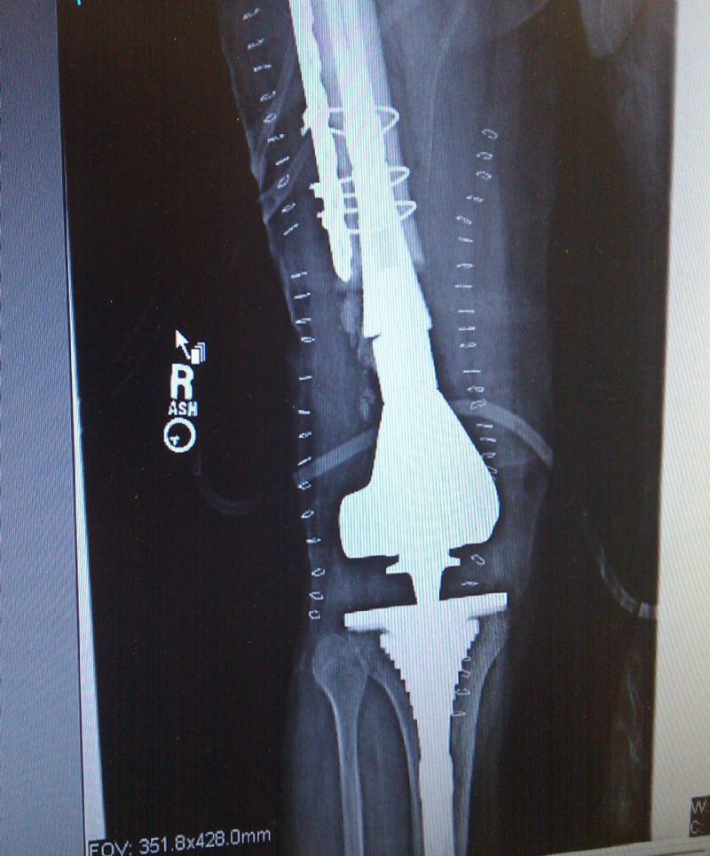 Knee Prostheses: Total, Revision - orthopaediclist.com