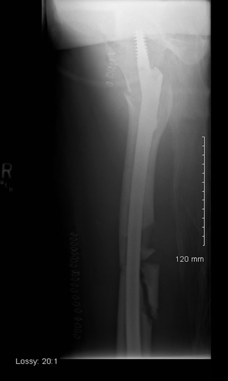 Hip Fracture Fixation (Femur, Proximal) - orthopaediclist.com