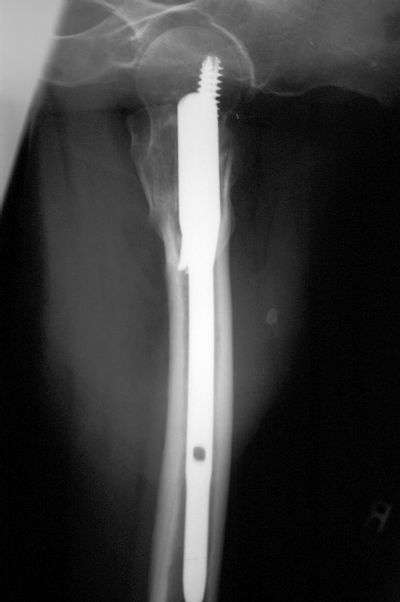 Hip Fracture Fixation (Femur, Proximal) - orthopaediclist.com
