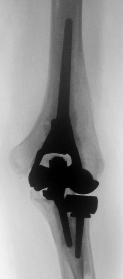 Implant Identification - orthopaediclist.com