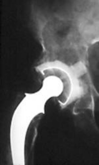 Implant Identification - orthopaediclist.com