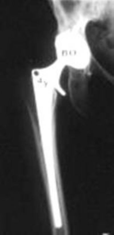 Zimmer HG Total Hip Prosthesis (Implant 3995) - orthopaediclist.com