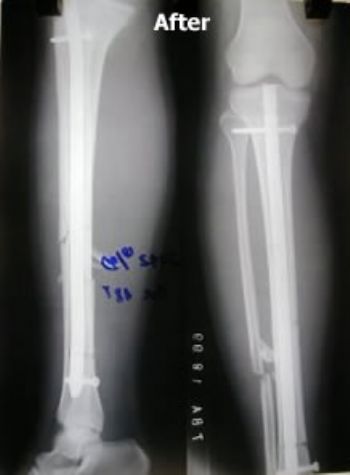 Femur Nails / Femur Rods - orthopaediclist.com
