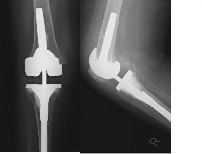 Knee Prostheses: Total, Revision - orthopaediclist.com