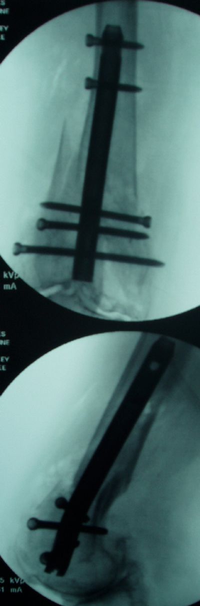 Implant Identification - orthopaediclist.com