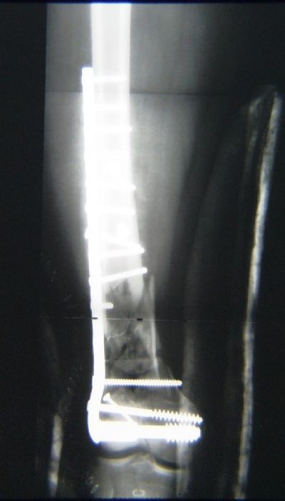 Femur Fracture Fixation: Distal - orthopaediclist.com