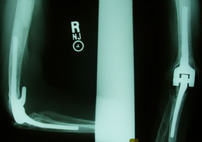Coonrad-Morrey Total Elbow Prosthesis (Implant 196) - orthopaediclist.com