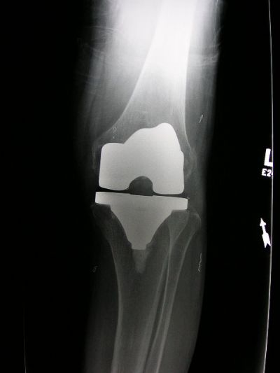 Stryker Scorpio (Implant 412) - orthopaediclist.com