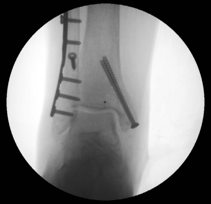 Implant Identification - orthopaediclist.com