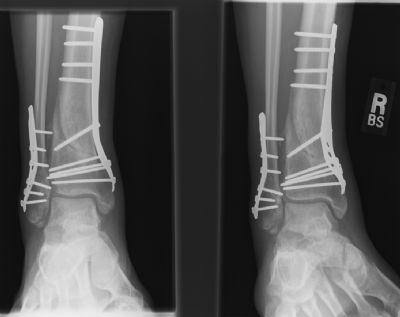 Implant Identification - orthopaediclist.com