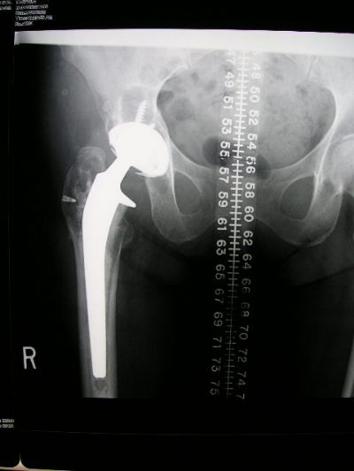 Implant Identification - orthopaediclist.com