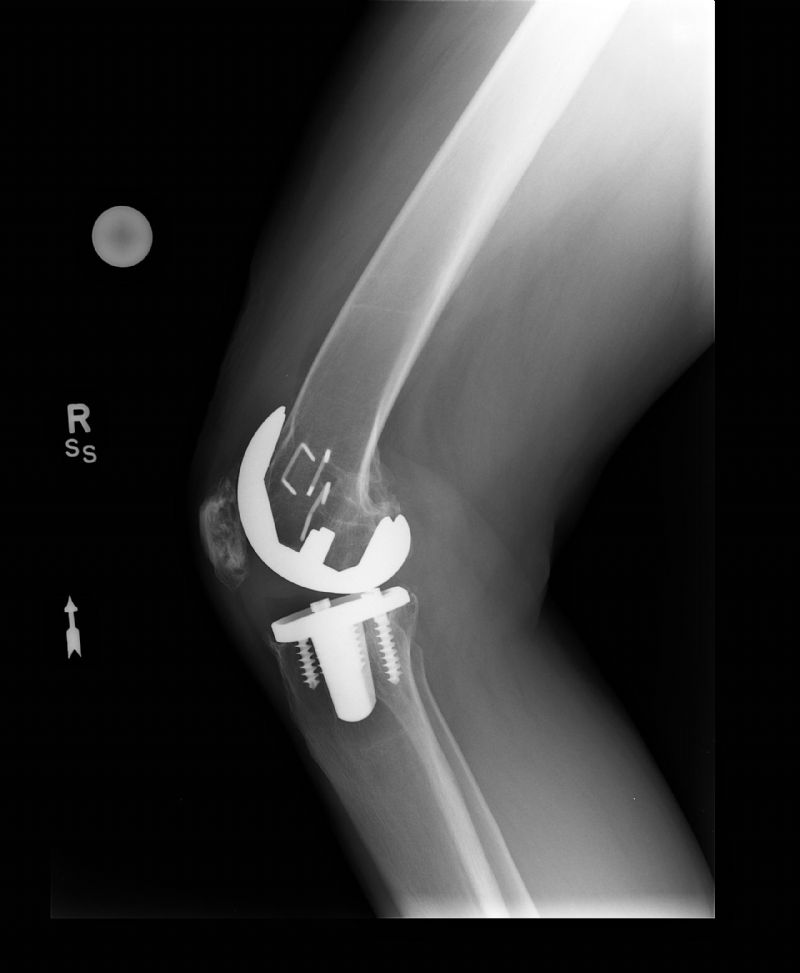 Knee Prostheses: Total, Primary - orthopaediclist.com