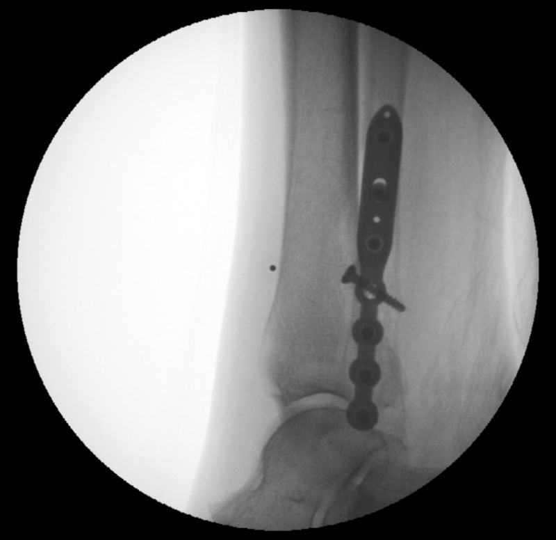 DePuy ALPS (Implant 4209) - orthopaediclist.com