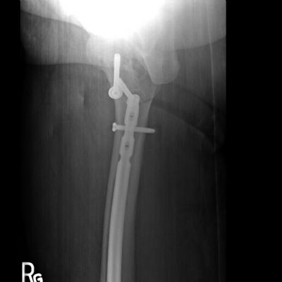 Femur Fracture Fixation: Distal - orthopaediclist.com