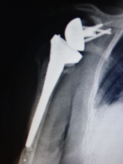Shoulder Prostheses - orthopaediclist.com
