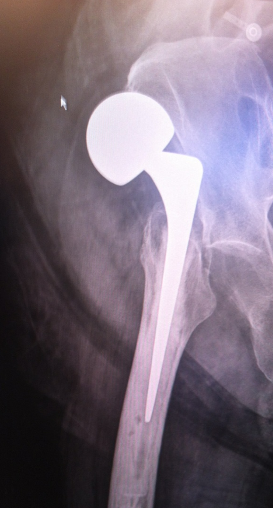 Zimmer CPT Stem Hemireplacement (Implant 1407071) - orthopaediclist.com