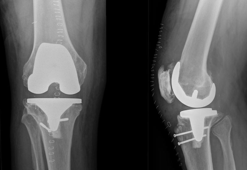 Knee Prostheses: Total, Primary - orthopaediclist.com