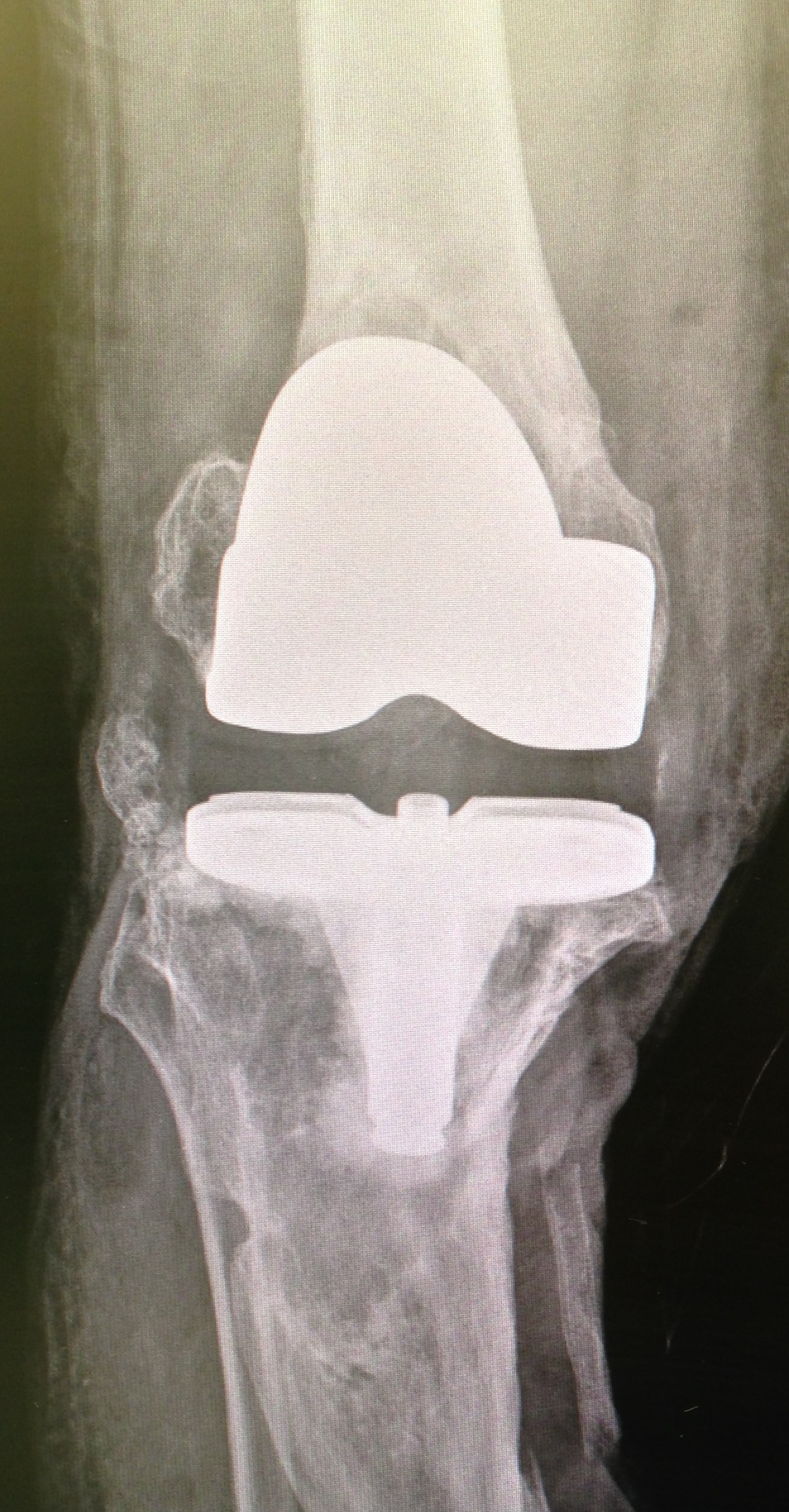 Zimmer Nexgen Knee Material at Judith Tomlin blog