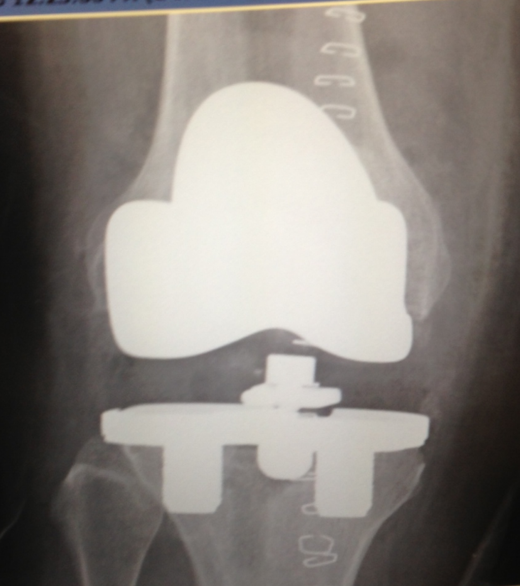 Zimmer NexGen CR (Implant 1407073) - orthopaediclist.com