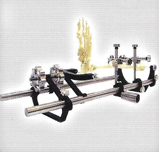 STORM Tibial Reduction Device (Prod 7610) - orthopaediclist.com