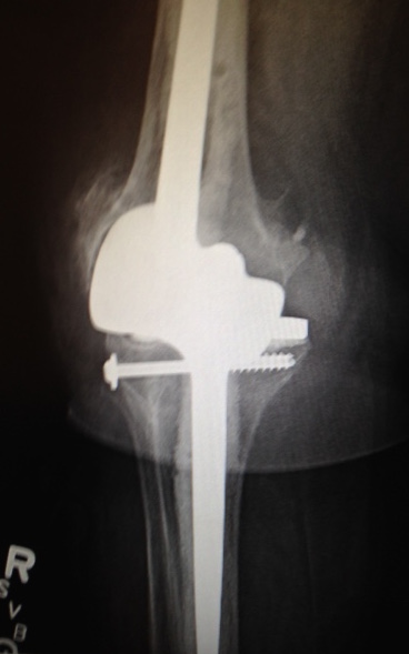 Link Endo Rotational Knee (Implant 1509111) - orthopaediclist.com