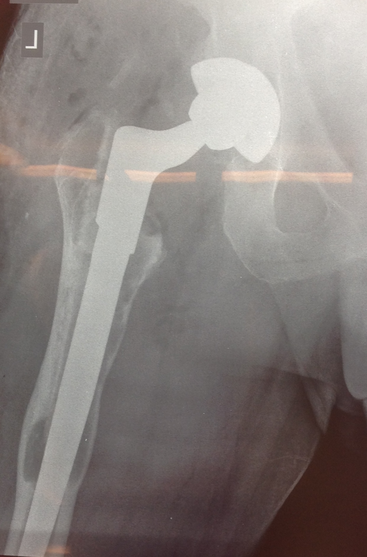 Hip Prostheses: Total, Revision - orthopaediclist.com